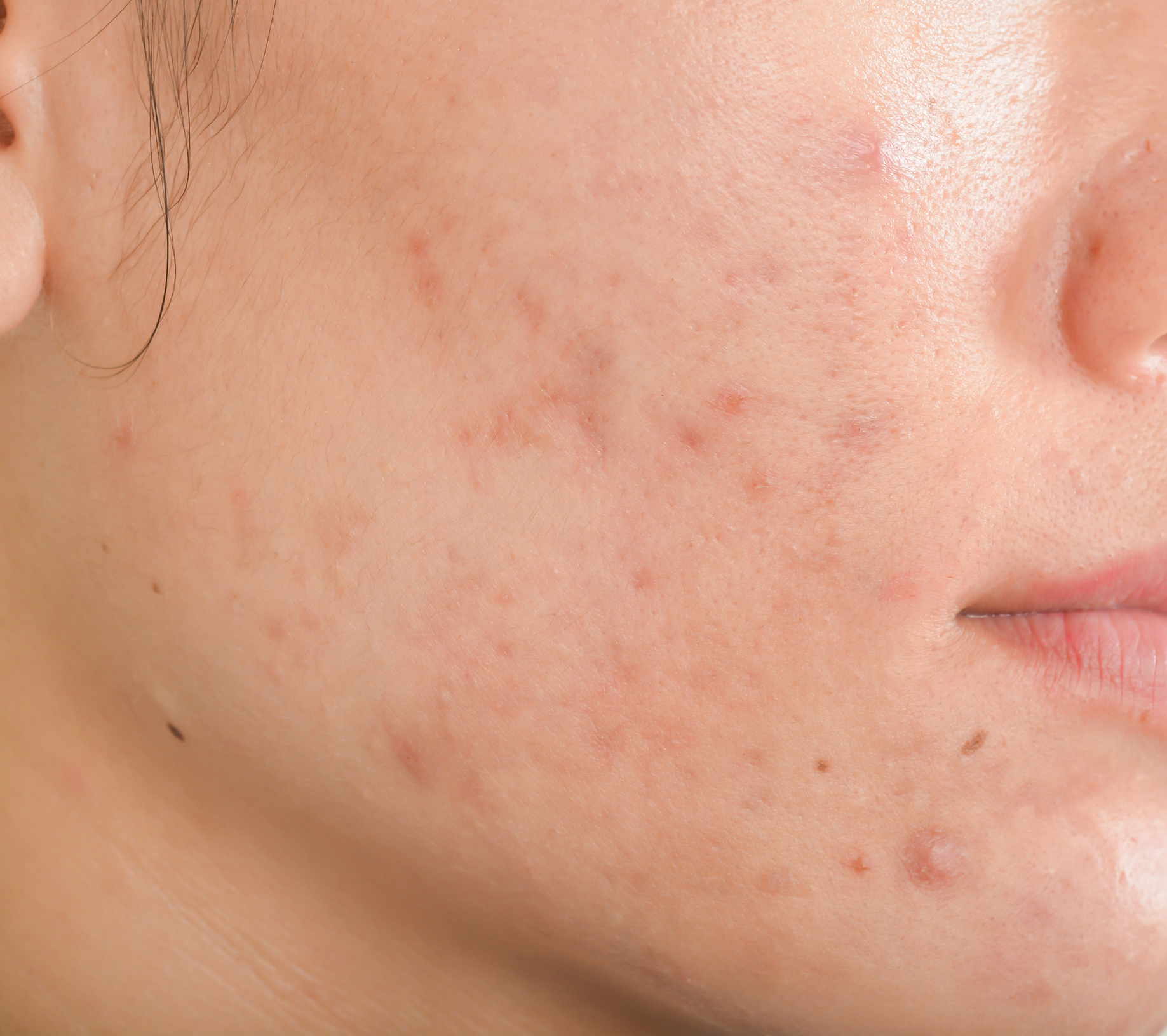 Everything You Need to Know About Acne - Guide - Market Share Group