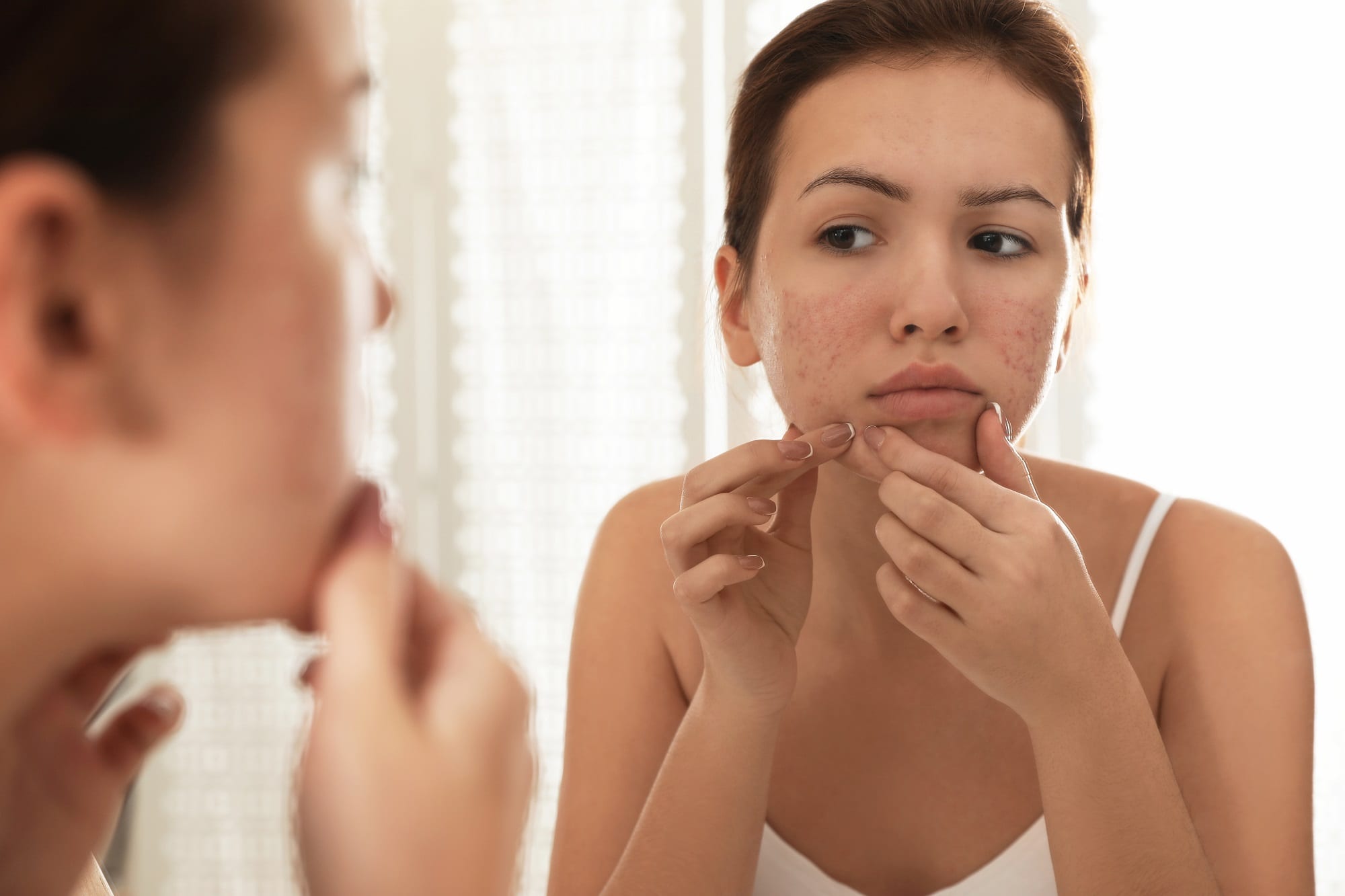 Everything You Need to Know About Acne - Guide - Market Share Group
